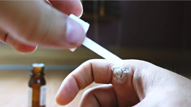 The Best Oils and Treatments to Remove Warts Naturally - Vibro Media