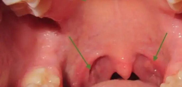 Why Is the Roof of My Mouth Itchy? Allergy or Infection 2026