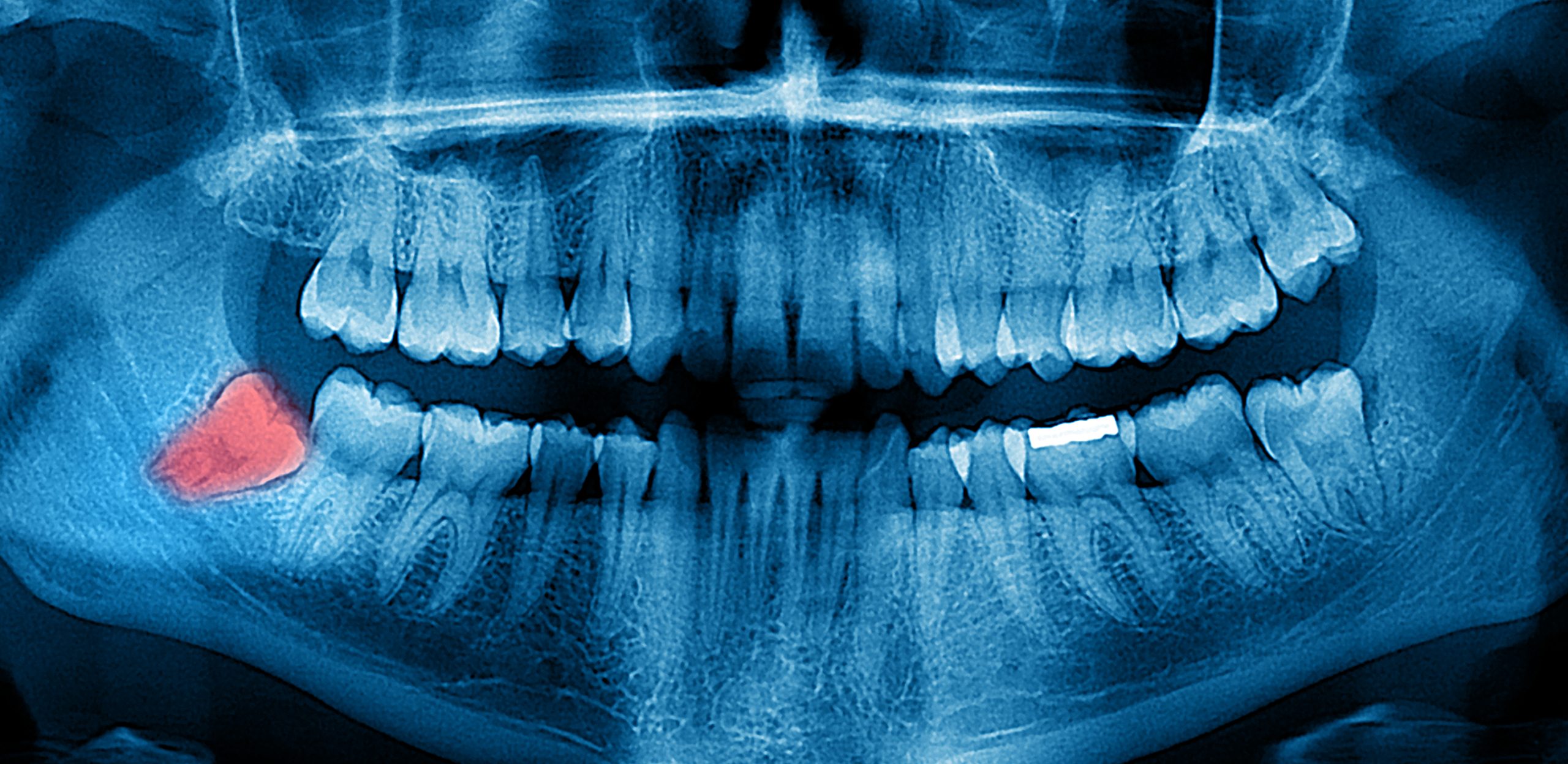 Why Are Wisdom Teeth Called Wisdom Teeth? Dental Meaning 2026